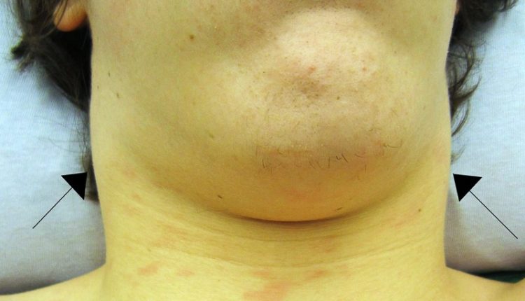 Linfonodi Ingrossati Medz