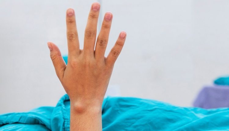 Cisti sebacea: una panoramica su questa cisti epidermoide