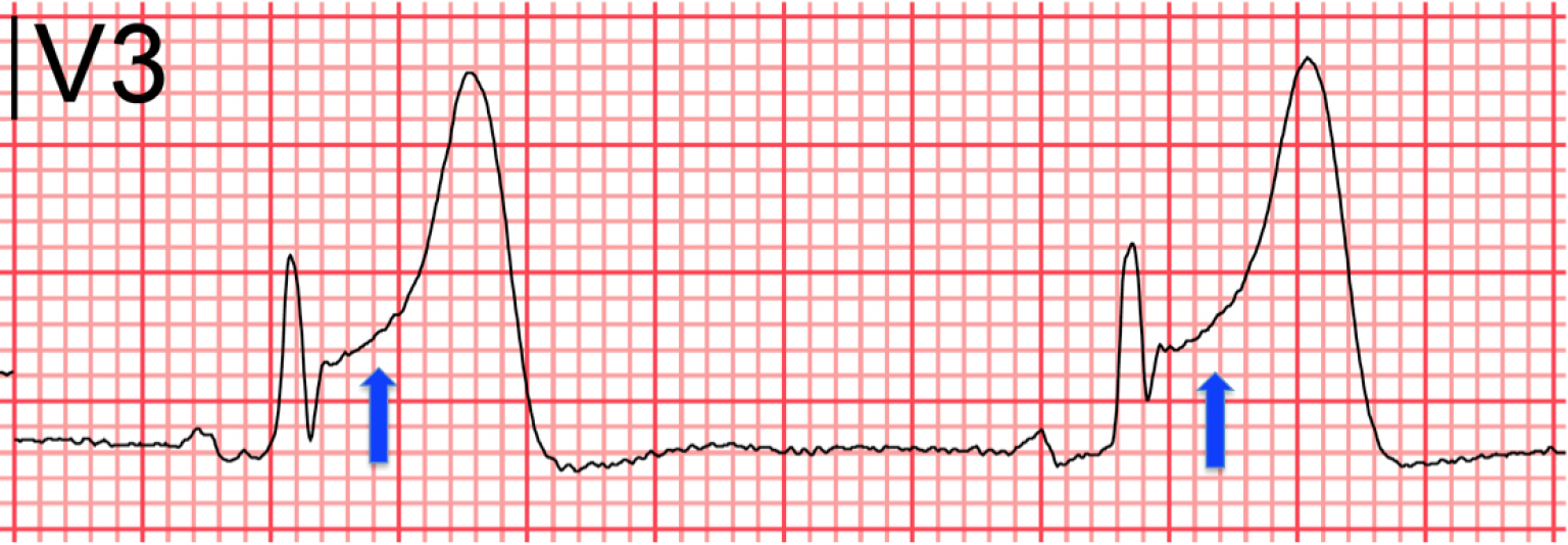 ST-Elevation Myocardial Infarction: What is a STEMI? | Emergency Live