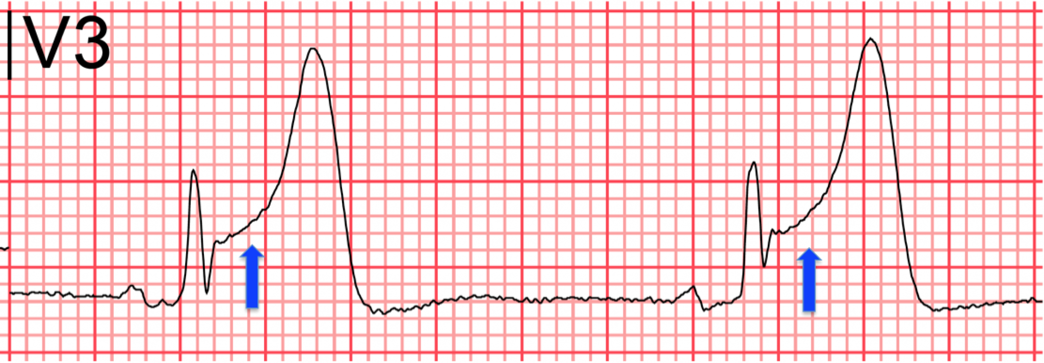 ST-Elevation Myocardial Infarction: What is a STEMI? | Emergency Live