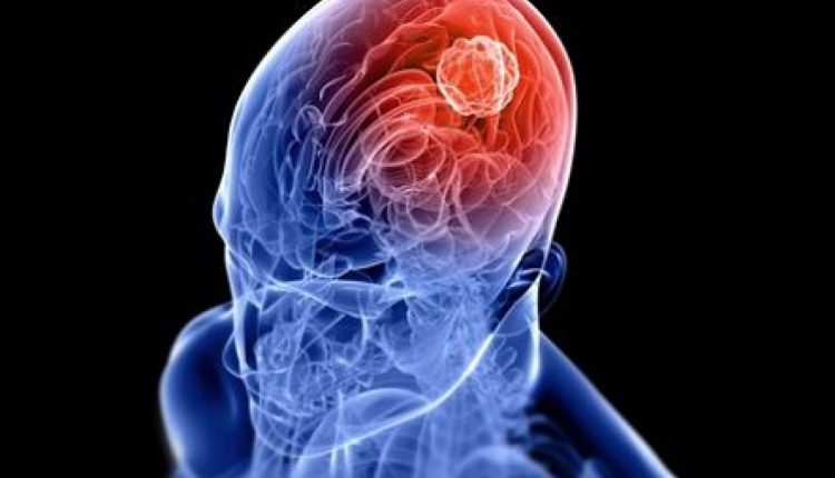 Hémorragie Cérébrale Causes Symptômes Traitements Urgence En Direct