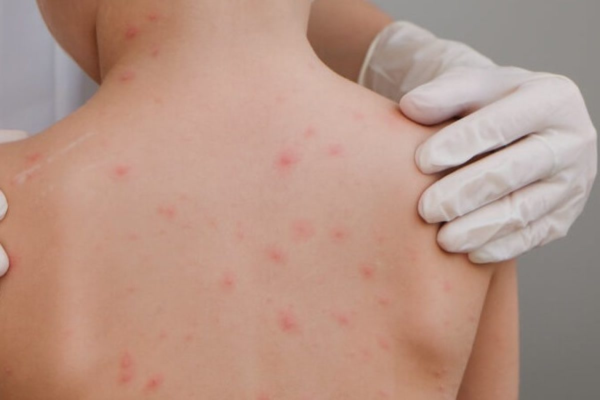 Mild Chicken Pox Pictures Early Stages