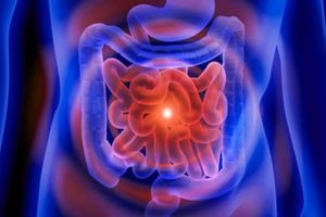 Chronic inflammatory bowel disease: Crohn's disease and ulcerative colitis