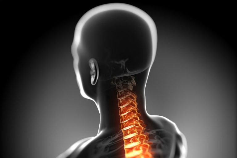 Cervical stenosis: symptoms, causes, diagnosis and treatment