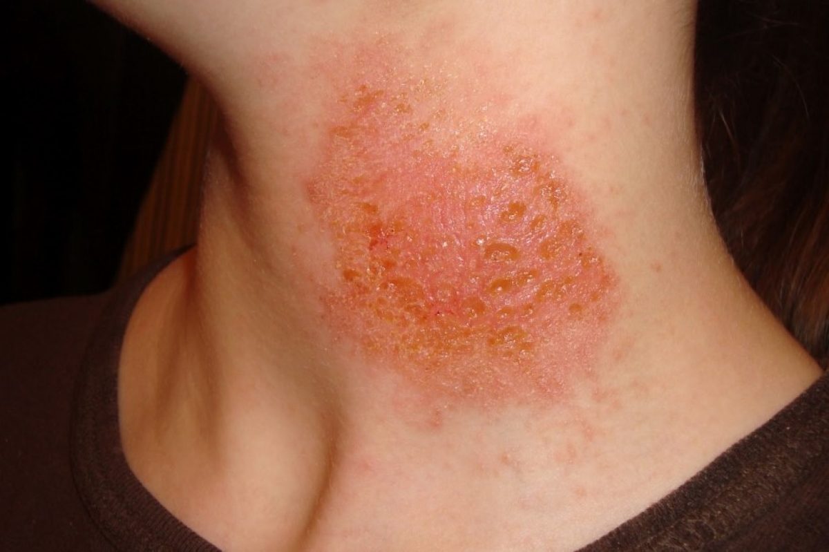 Allergic Contact Dermatitis Nickel