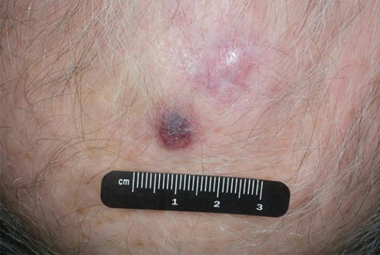 What is angiosarcoma? Symptoms, diagnosis and treatment