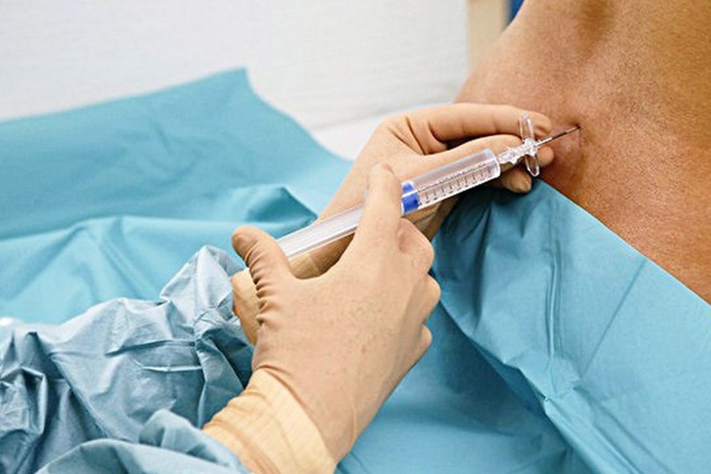 Epidural For Pain Relief After Surgery | Emergency Live