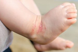 Transient neonatal dermatosis? Don't worry, here's what they are