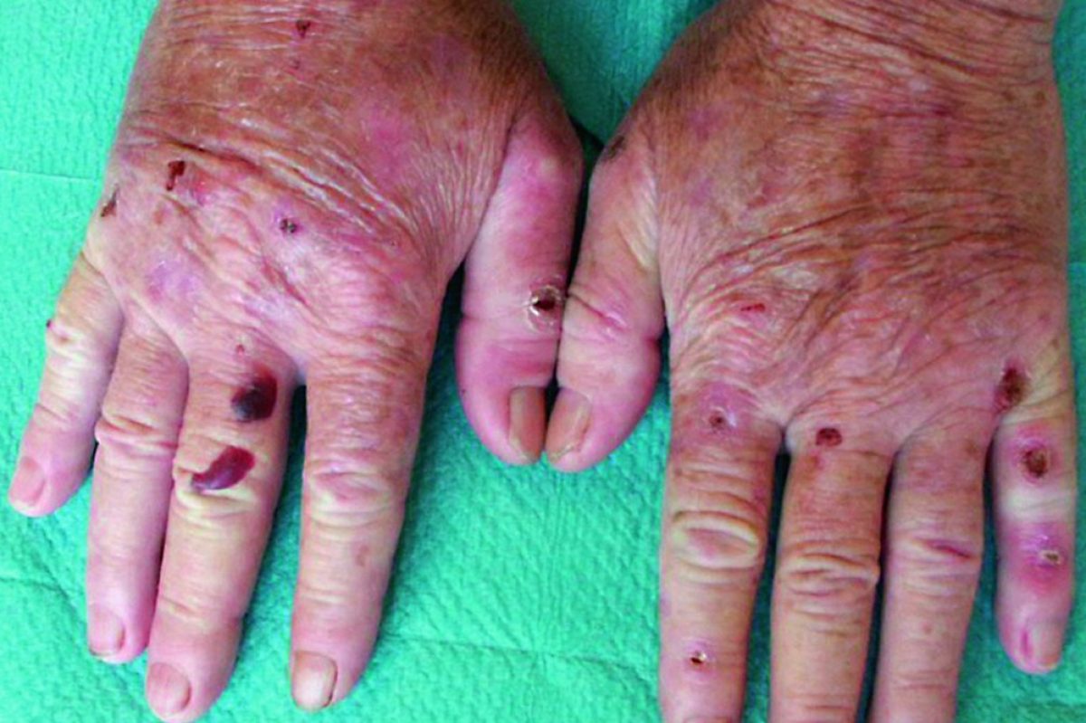 Porphyria Purple Poop