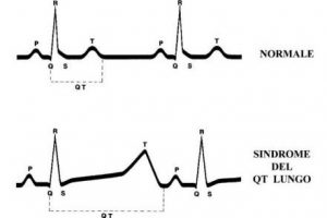 Long QT syndrome: causes, diagnosis, values, treatment, medication
