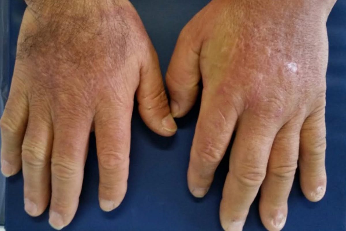 Crest Scleroderma Scalp