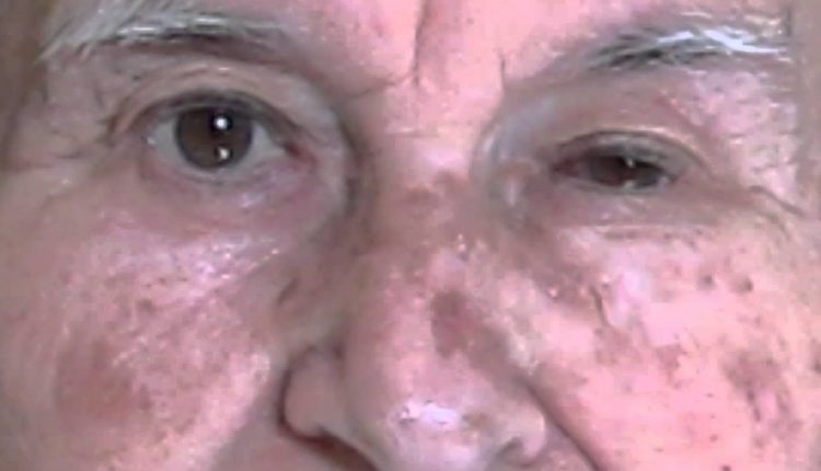 Essential blepharospasm: what it is and what it can be a symptom of