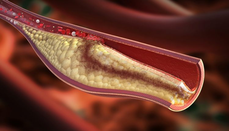 Atherosclerosis: what it is, what causes it and how to treat it