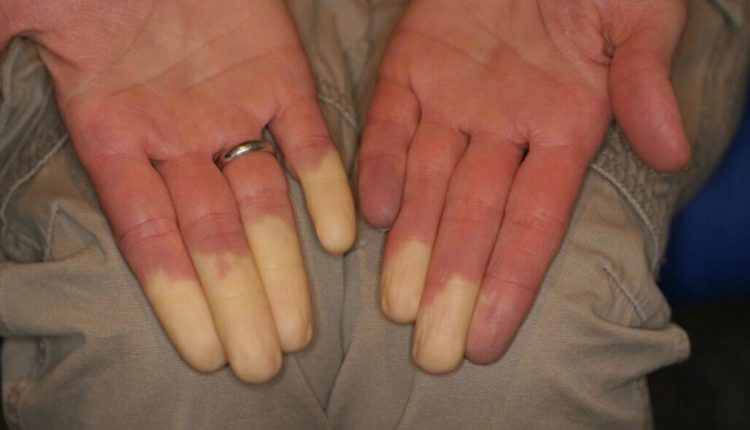 Raynaud's syndrome: symptoms, causes and treatment