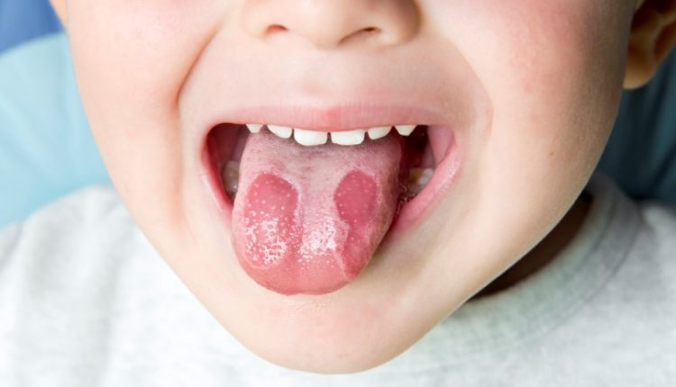 Viral stomatitis: what to do? | Emergency Live