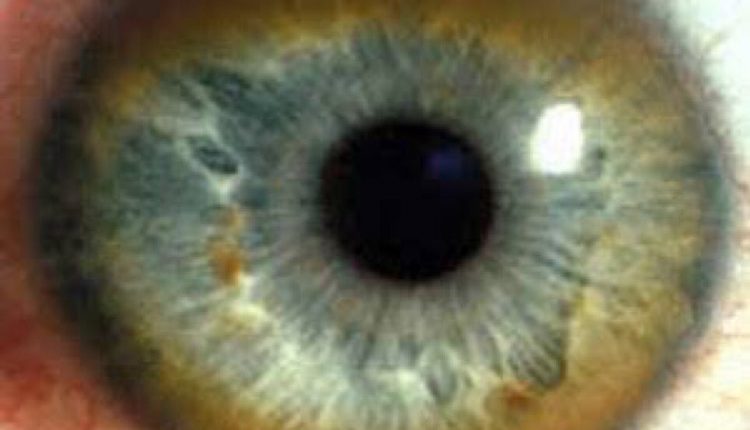 Wilson's disease: what are the symptoms | Emergency Live