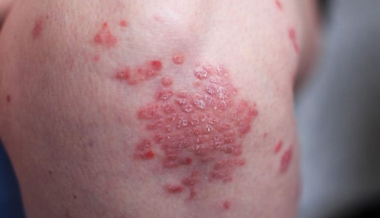 Guttate psoriasis: causes and symptoms | Emergency Live