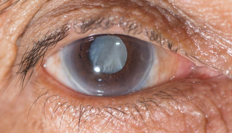 Cataract surgery with intraocular lenses to correct visual defects