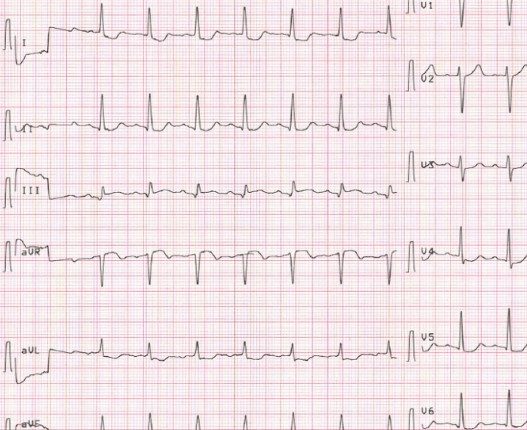 Aslanger Pattern: Another OMI? | Emergency Live