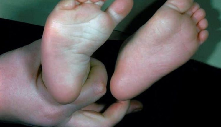 Foot deformities: metatarsus adductus or metatarsus varus
