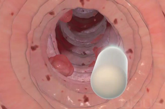 Capsule endoscopy: what it is and how it is performed