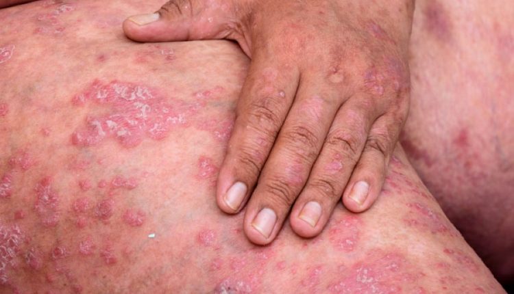 What Is Pustular Psoriasis Causes Symptoms And Treatment