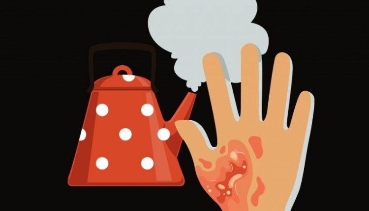 First Aid, Identifyng a Severe Burn | Emergency Live
