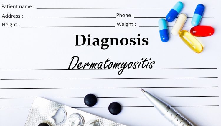 Dermatomyositis: symptoms, diagnosis and treatment