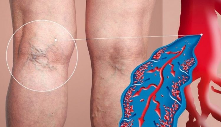 How to know if you have Deep Vein Thrombosis (DVT)?