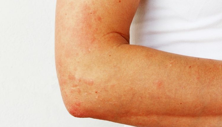 Photodermatosis: what is it? | Emergency Live