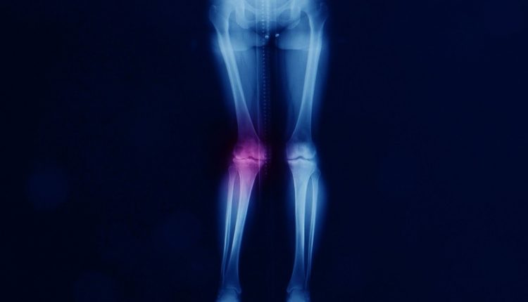 You have X-legs: discovering valgus knee together