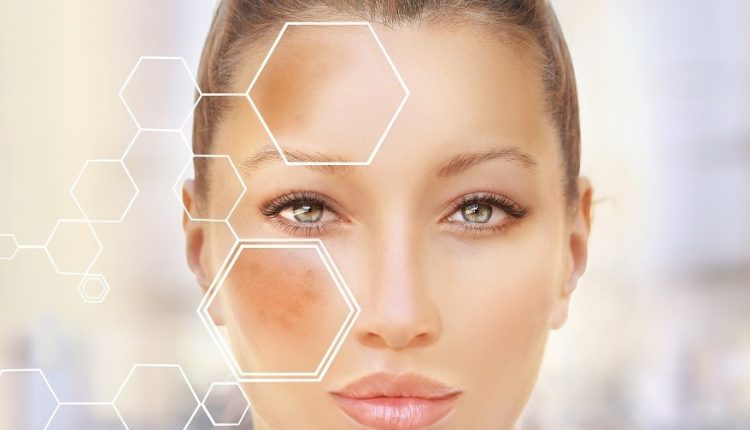 Melasma, a skin disorder due to hypermelanosis | Emergency Live