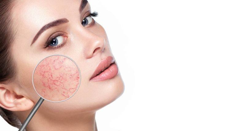 Rosacea, here's what to do for your skin's health | Emergency Live