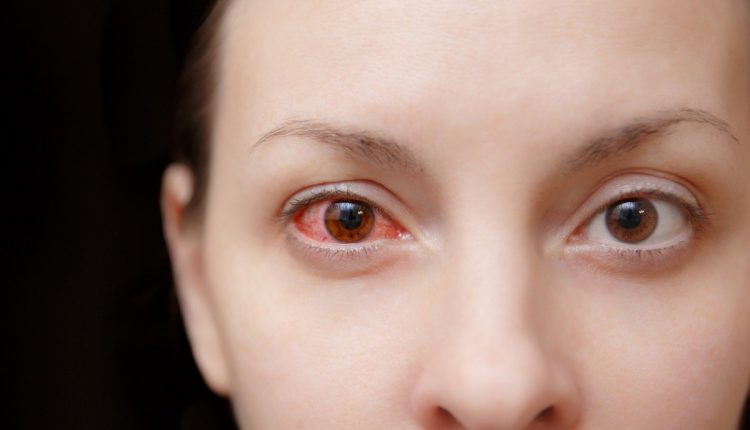 Red eyes: causes, symptoms, diagnosis and treatment