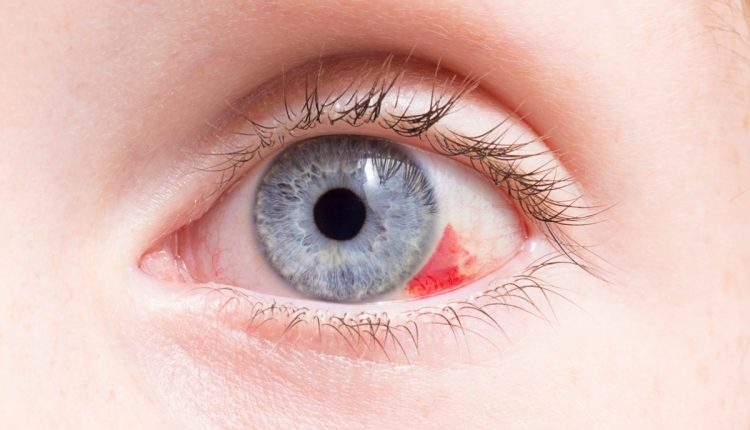 Blood in the eye? Often everything is ok, but...