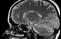 Maneuver and positive or negative Murphy's sign: what are they